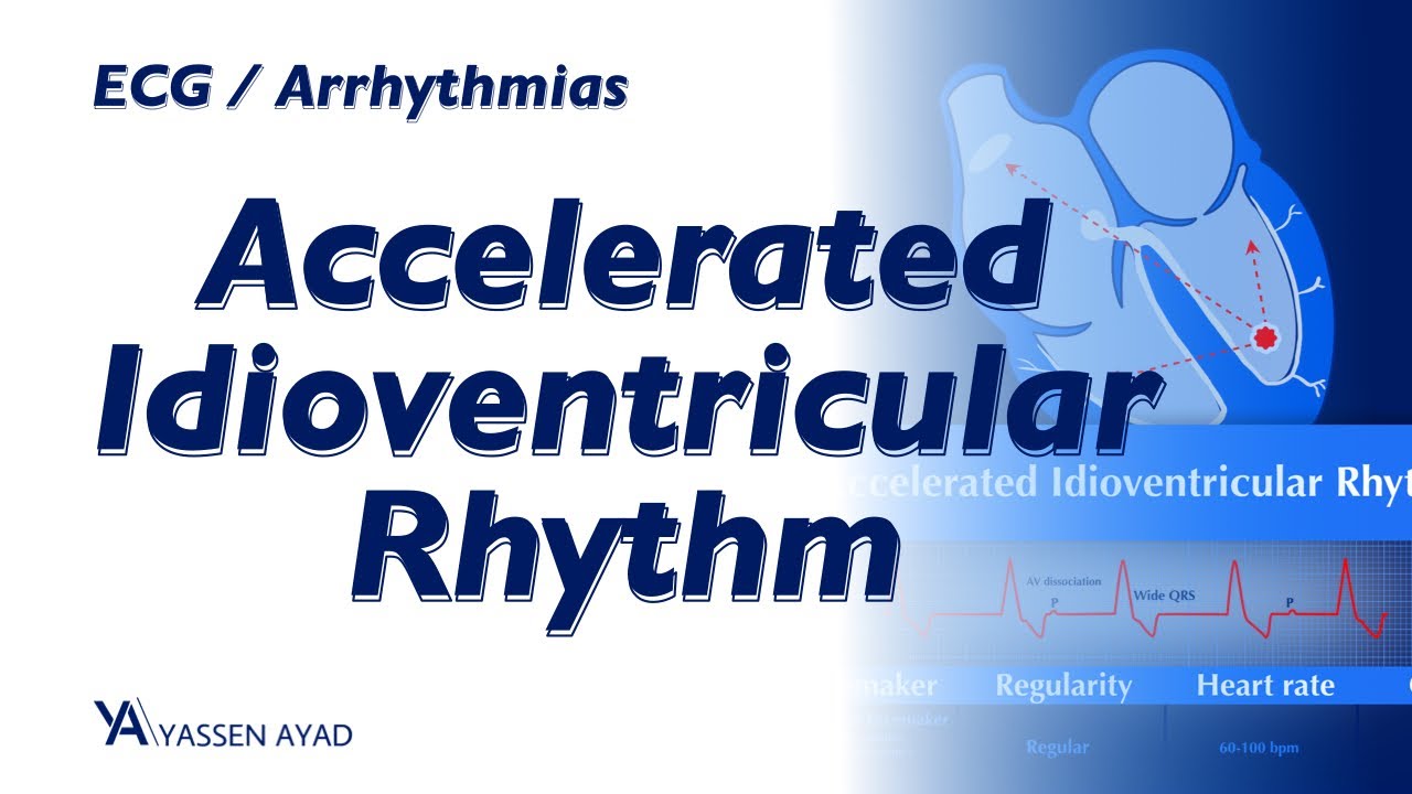 ECG 59 | Accelerated Idioventricular Rhythm - YouTube