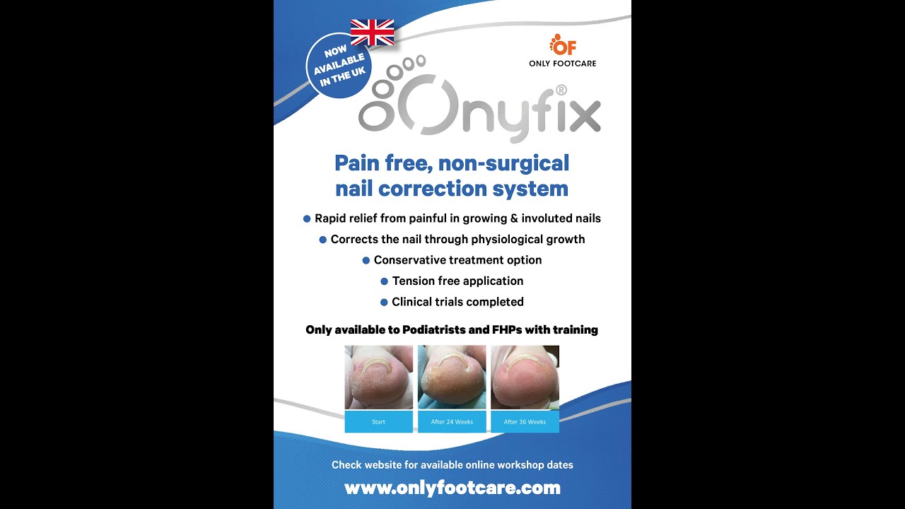 Onyfix nail correction system - YouTube