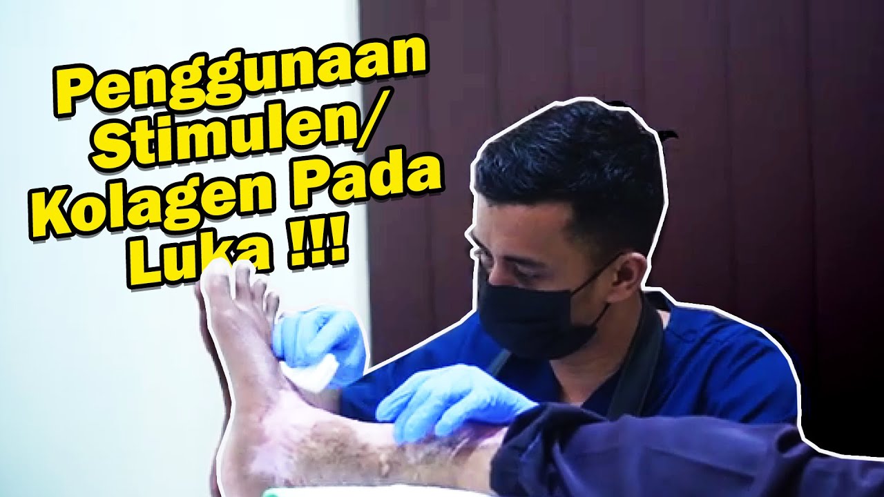 Penggunaan stimulen kolagen pada luka Granulasi - YouTube