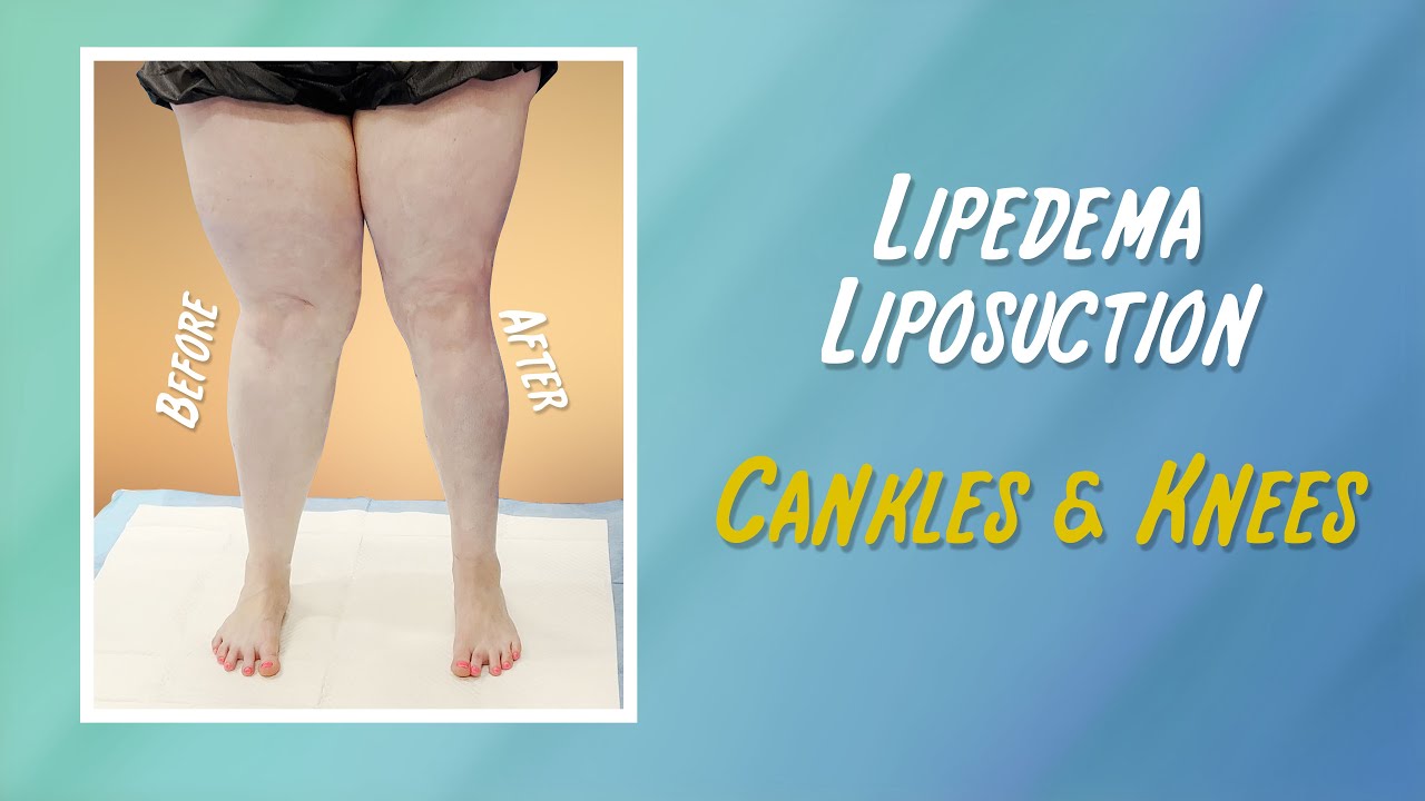 Lipedema | Leg Liposuction Surgery Results | Lipo 360° Legs | Cankles ...