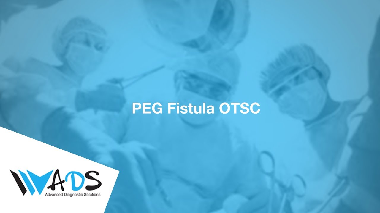 PEG Fistula OTSC Video 05 - YouTube
