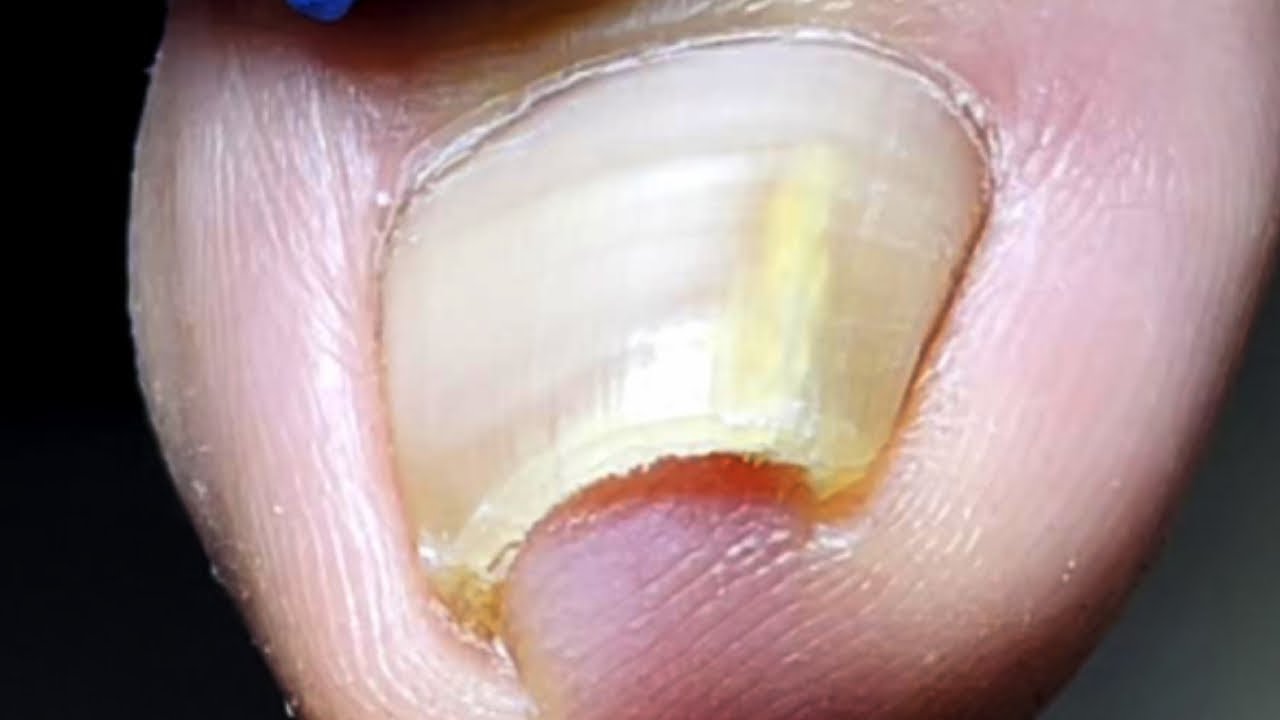 Curled Toenails, Large Ingrown Toenails Cut Out - YouTube