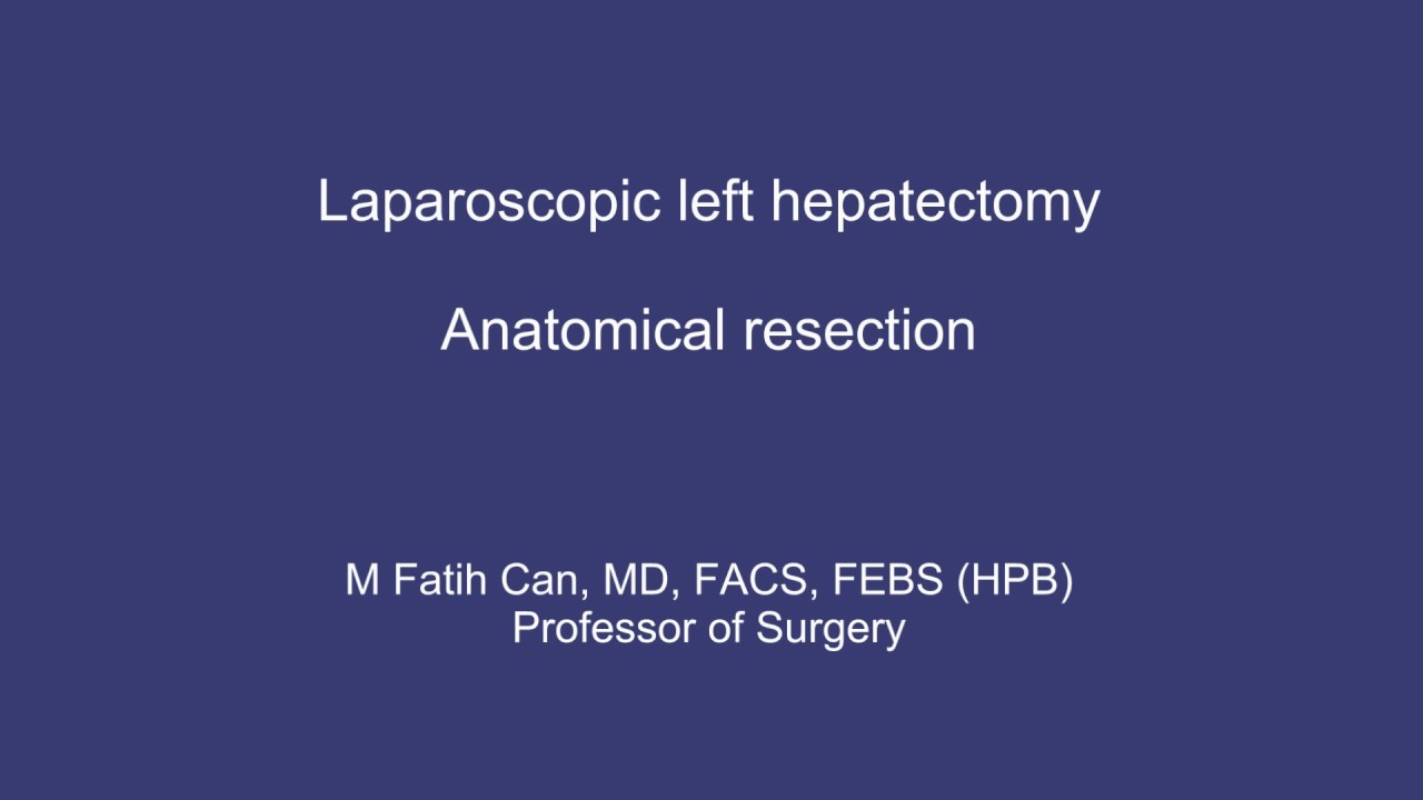 Laparoscopic left hepatectomy - Easy technique Full HD - YouTube