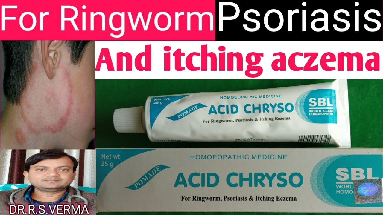Acid cryso oinment ! दाद खाज खुजली के लिए बेस्ट होम्योपैथिक उपचार।for ...
