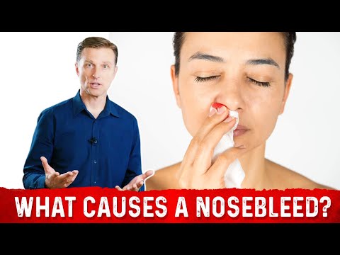 What Causes Nosebleeds/Epistaxis – 8 Common Causes of Nose Bleeding – Dr.Berg