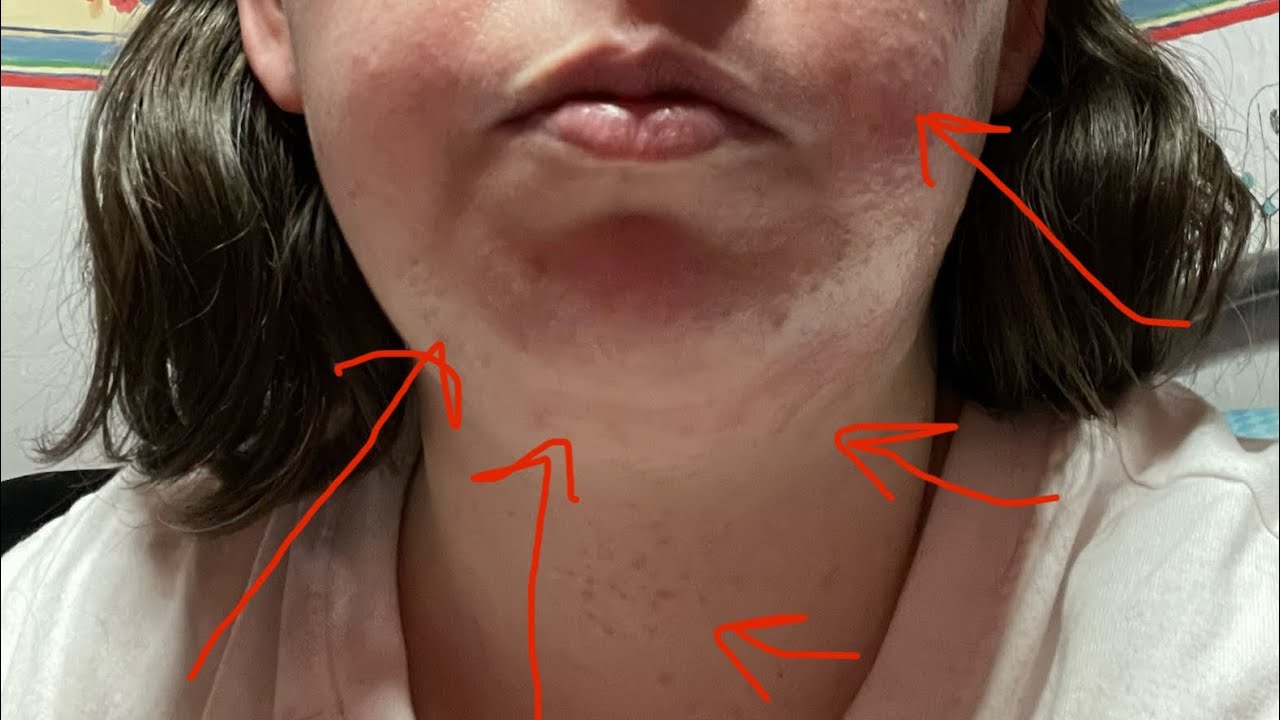 Day 2 with the infectious rash and still spreading - YouTube