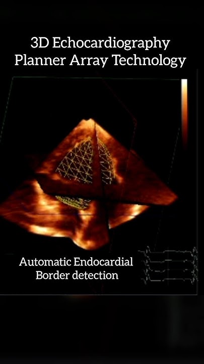 3D Echocardiography - Planner Array Technology makes endocardial border ...