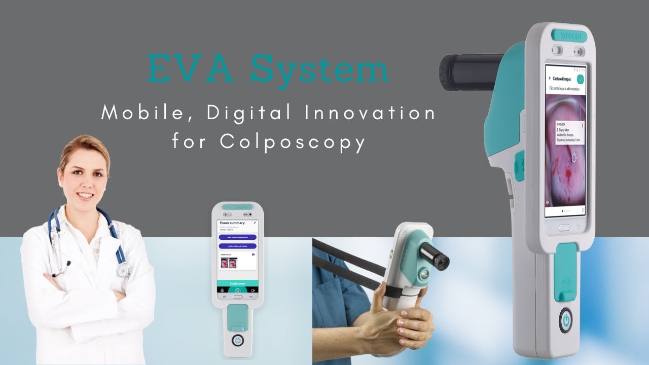 EVA System from MOBILE ODT - Innovation for Colposcopy - YouTube