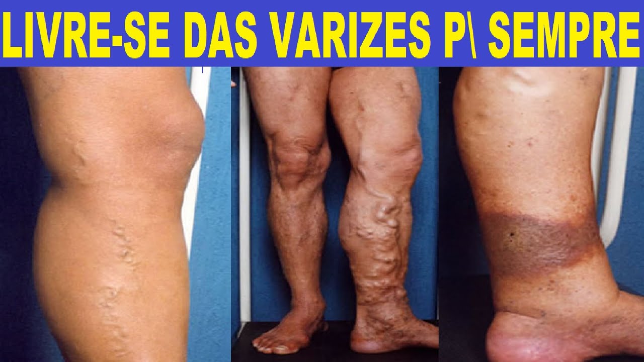 LIVRE-SE DAS VARIZES PARA SEMPRE COM O USO DE UM INGREDIENTE SIMPLES ...