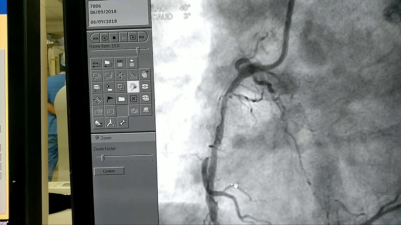 In stent restenosis (ISR) - YouTube
