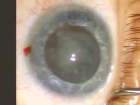 Tim Perozek, MD 2 -21-18 miLOOP - YouTube