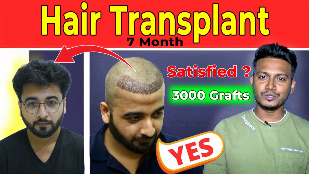 Life After Hair Transplants II What to Expect & How to Care for Your ...
