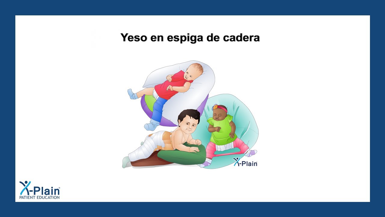 Yeso en espiga de cadera - YouTube