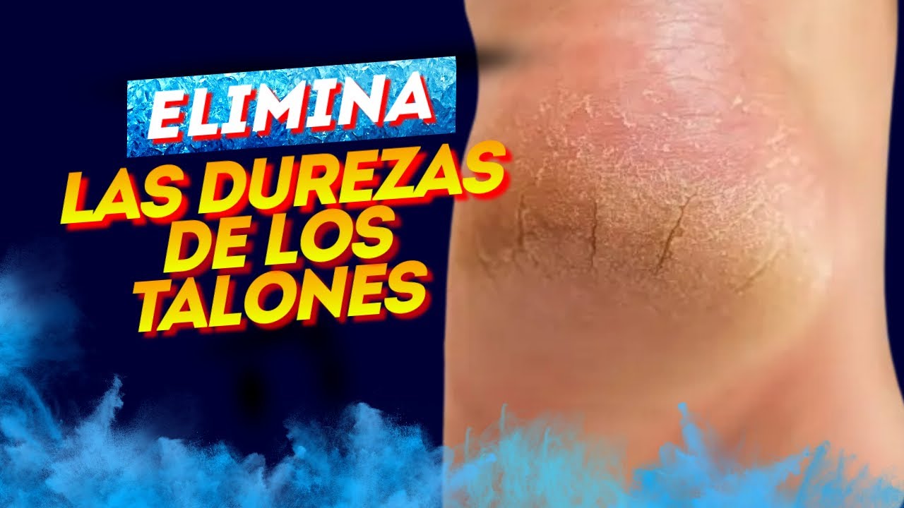 Cómo QUITAR Las Durezas de Los TALONES - YouTube