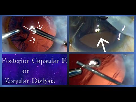 Is this a Posterior Capsular Rent or a Zonular Dialysis - How to tell ...
