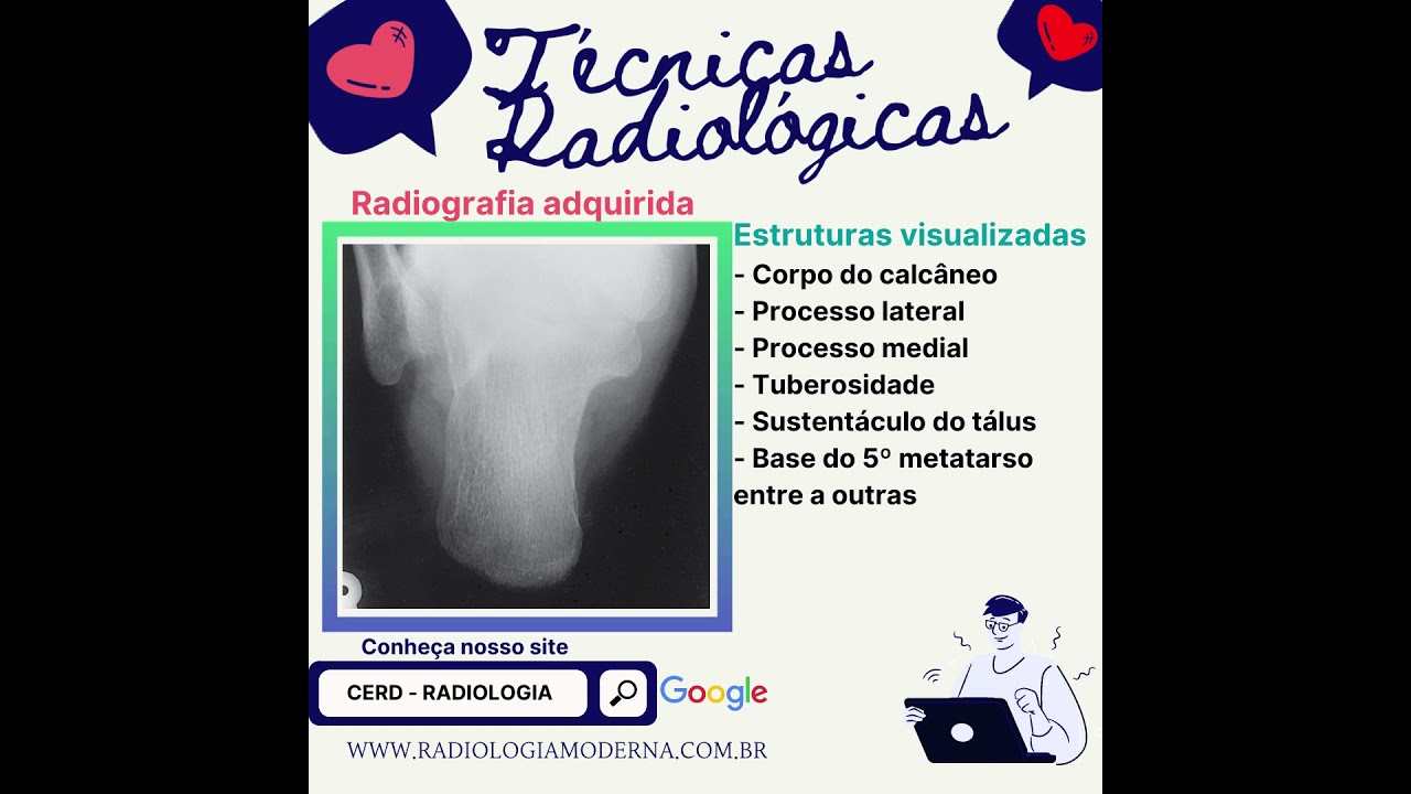 Técnicas Radiológicas do Calcâneo axial plantodorsal - YouTube