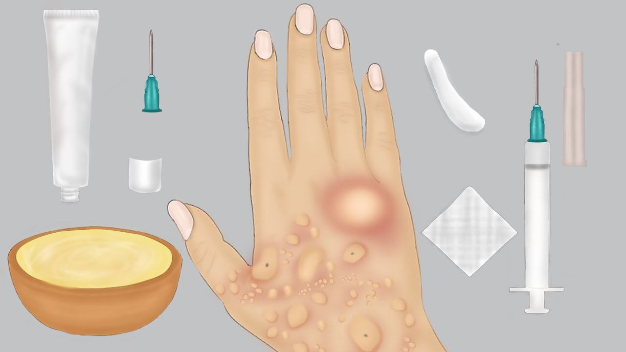 Treatment of skin disease on the hand and large acne - YouTube