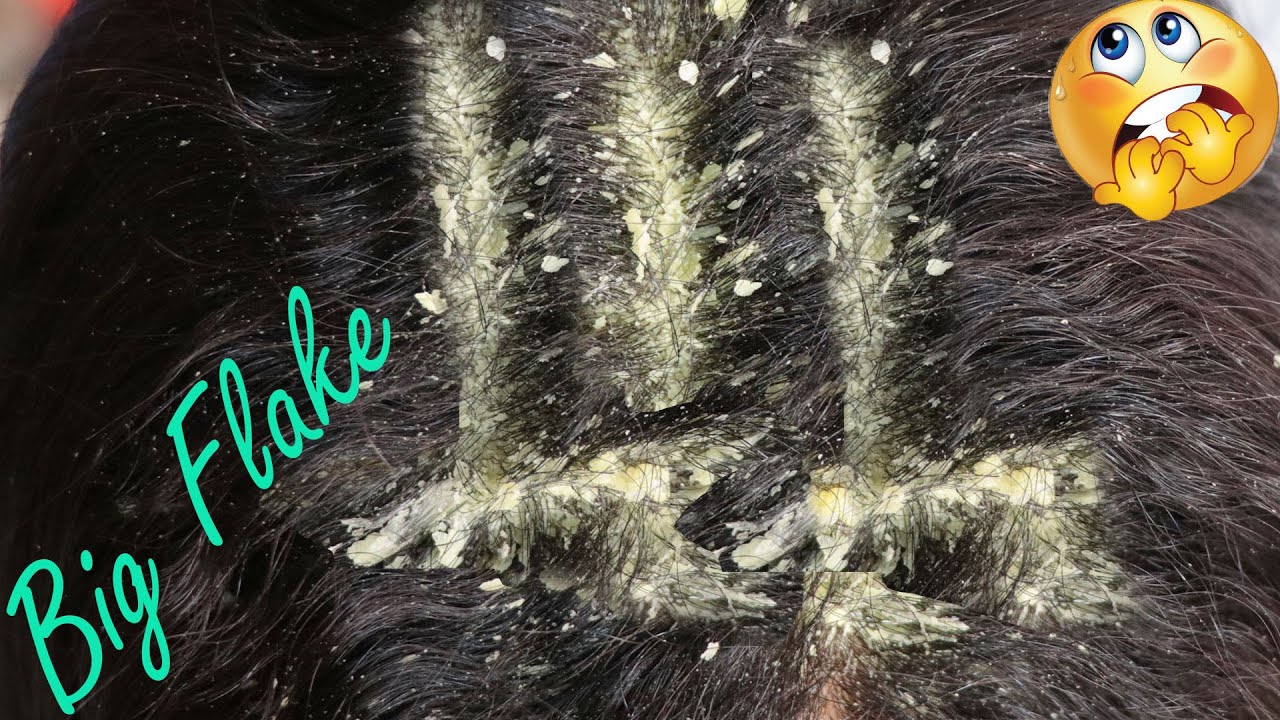 1BIG DANDRUFF FLAKES | Satisfying Dandruff Removal | Scalp scratching ...