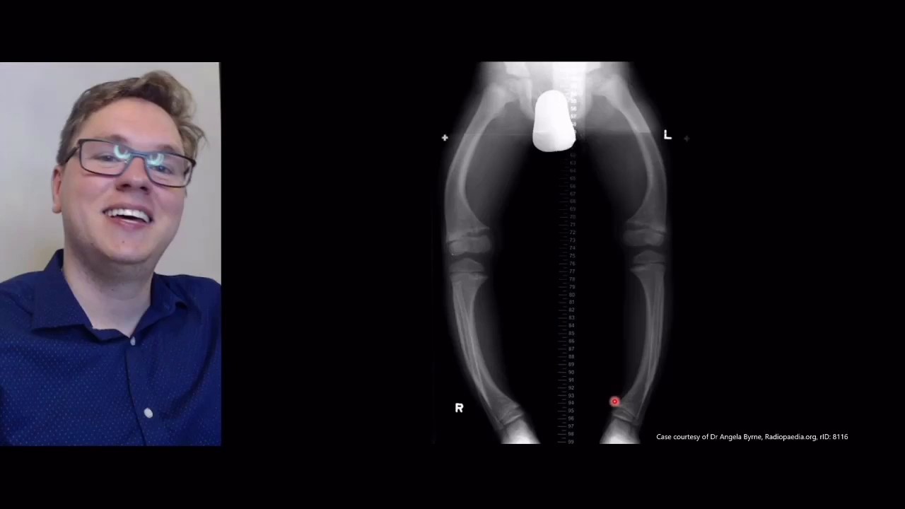 Raquitismo | Quando suspeitar no RX? - YouTube