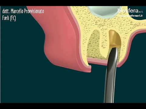 Estrazione di radice di molare superiore per via ordinaria - YouTube