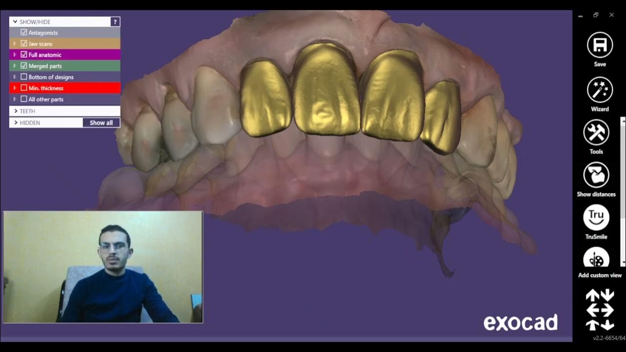 Highlights:expert mode and tools part 1 in exocad شرح بالعربي - YouTube