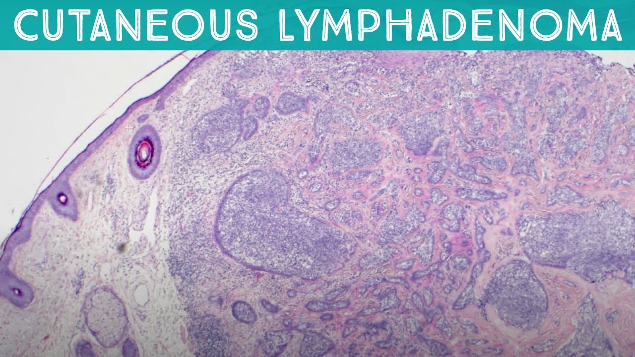 Cutaneous Lymphadenoma (aka adamantinoid trichoblastoma): Dermpath in 5 ...