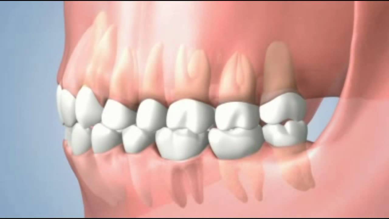 single tooth consequences - YouTube