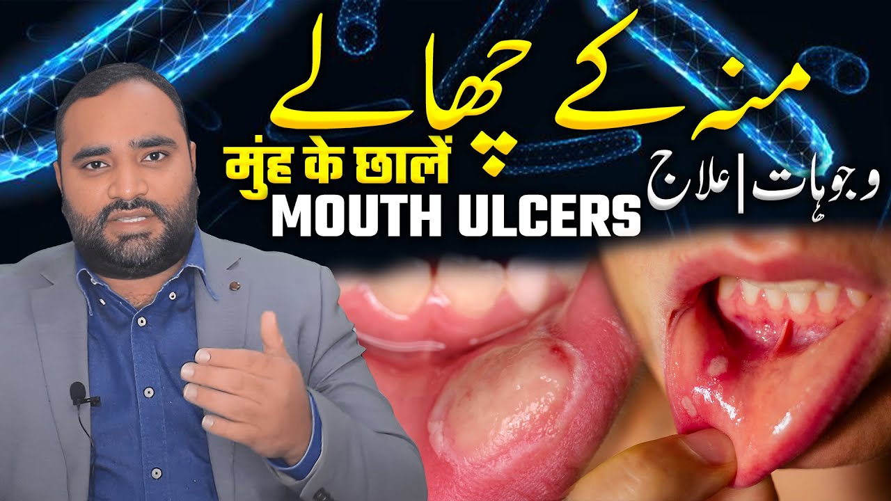 Mouth Ulcers | Munh Men Chale Kyun Hote Hain | Munh Mein Chhale Ka Ilaj ...