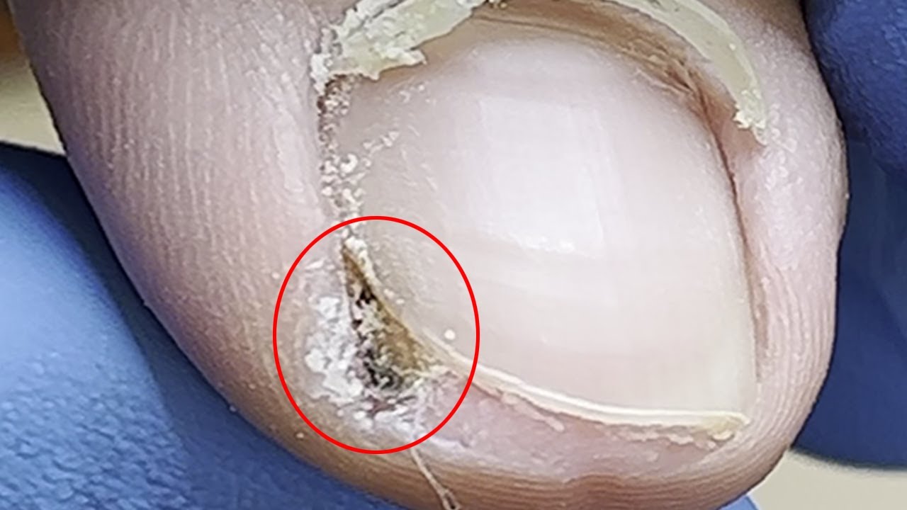 Too long toenails squeezing, digging out dirt【Xue Yidao Pedicure】 - YouTube