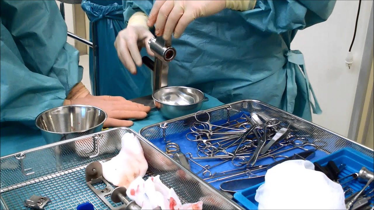 Mini Bone Mill - HB Medical - YouTube