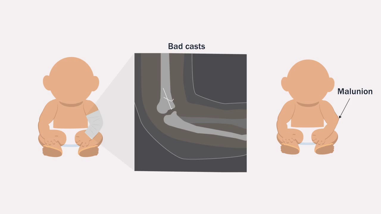 Infantile Supracondylar Humeral Fractures (Patients Less Than Two Years ...