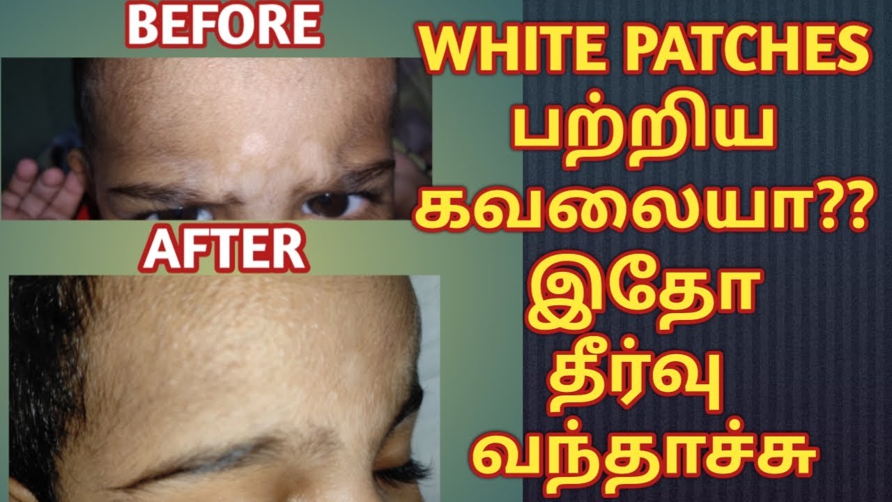 How To Treat White Patches On Face shoulder Neck For Babies And how-to-treat-white-patches-on-face-shoulder-neck-for-babies-and