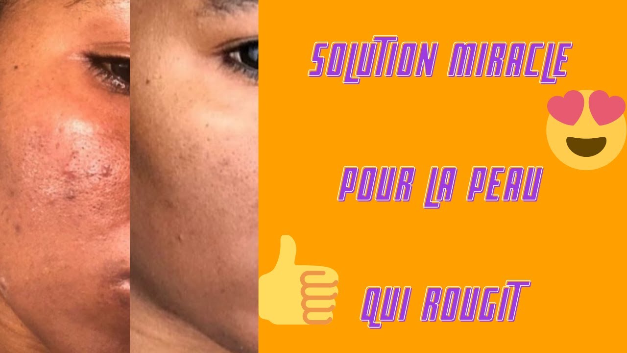 TU AS LA PEAU QUI ROUGIT ? REGARDE CETTE VIDÉO - YouTube