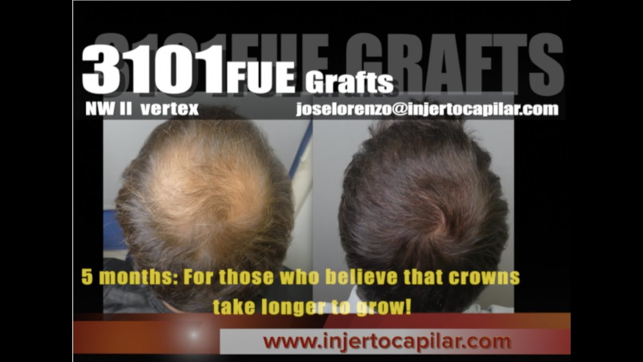 3101FUE Grafts.NW IIvertex.Crown restoration. Full coverage at 5 months ...