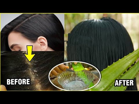 How To Use Aloe Vera, lemon & coconuts oil For Dandrufft treatment At Home | Effective  Removal