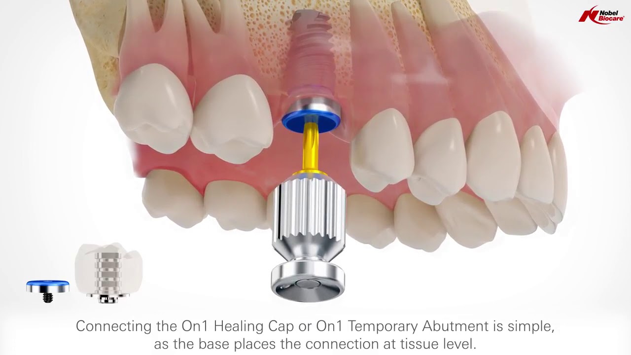 On1 restorative concept Nobel Biocare - YouTube