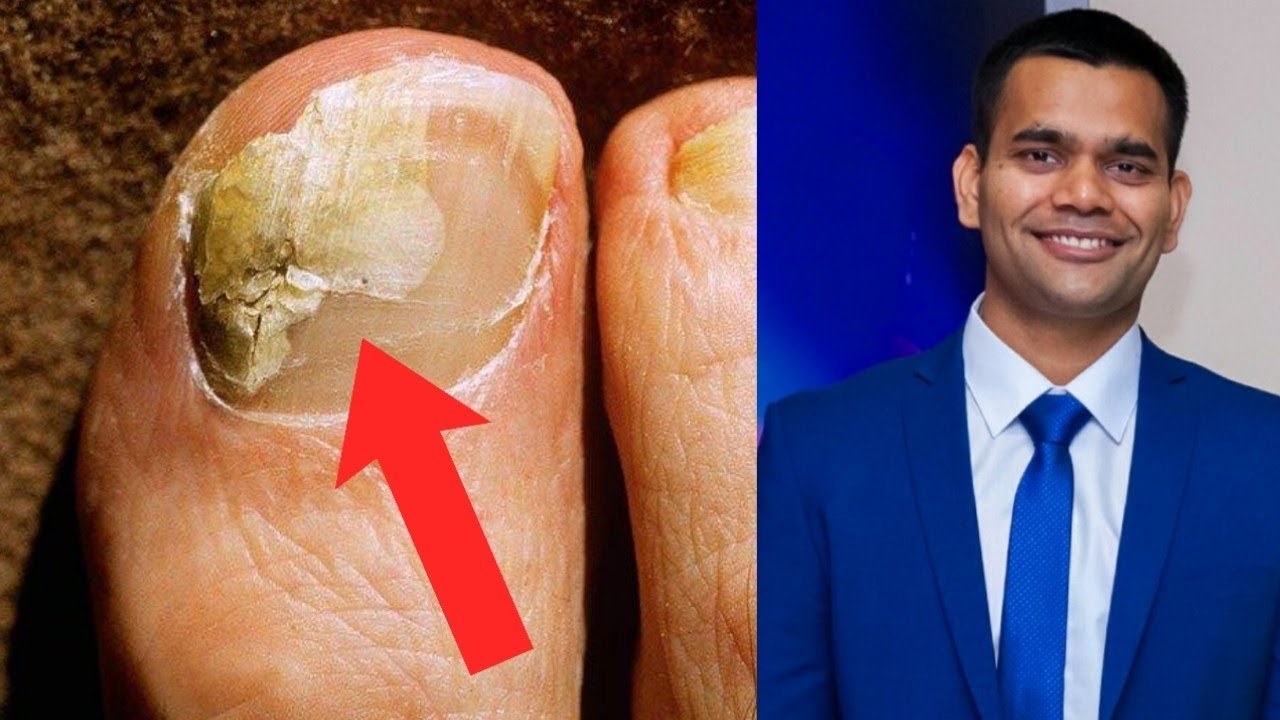 Distal Subungual Onychomycosis Home Remedies