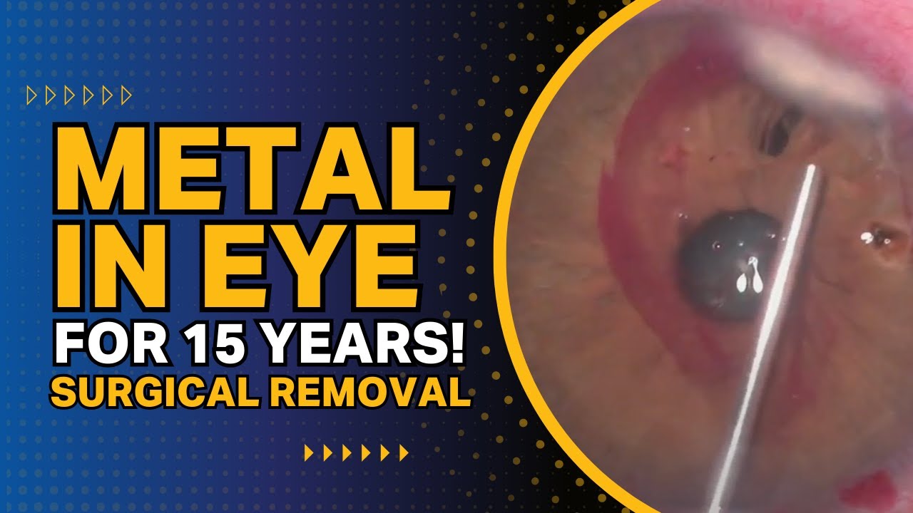 Metal in Eye for 15 Years! Surgical Removal - YouTube