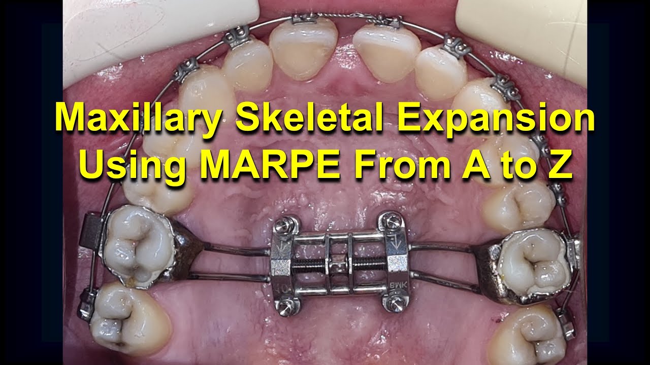 Maxillary Skeletal Expansion using MARPE from A to Z (Updated) - YouTube