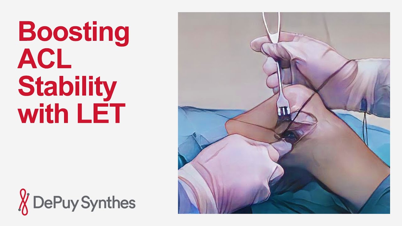 Lateral Extra-Articular Tenodesis (LET) Technique with VERSALOOP All ...