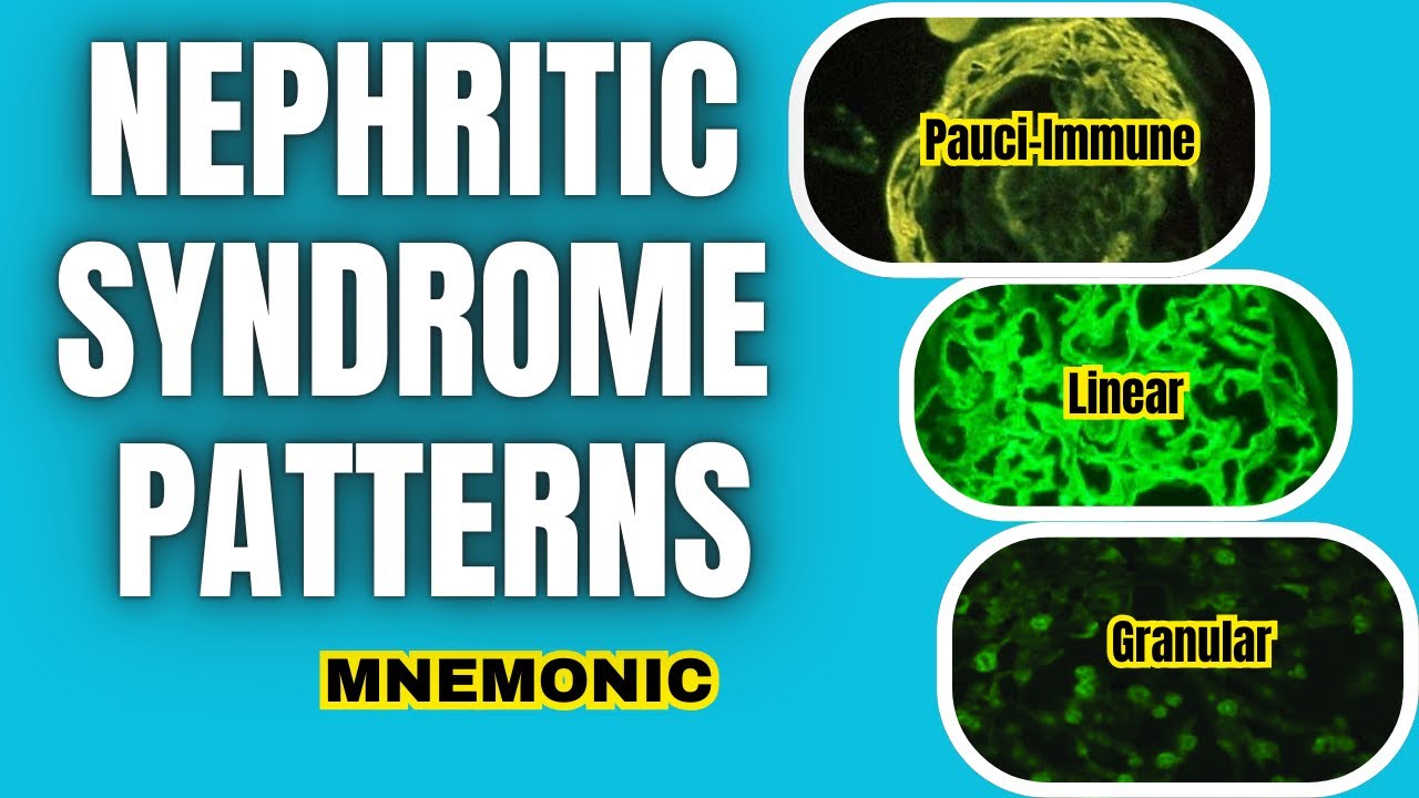 Mnemonic For Nephritic Syndrome Patterns [Electron Microscopy ...