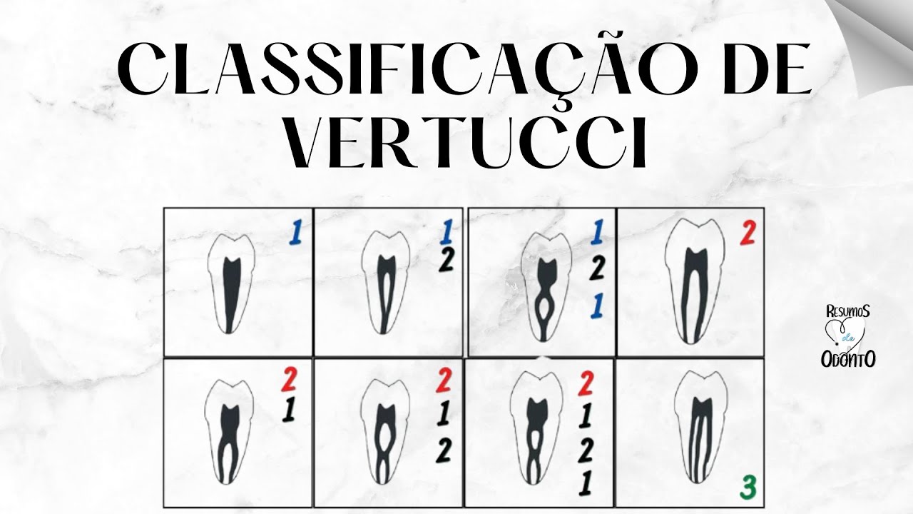 Classificação de Vertucci | Resumos de Odonto - YouTube