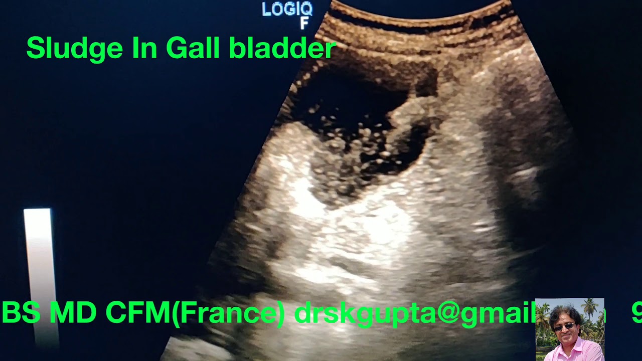 Sludge Tumfective in Gall Bladder on Ultrasound - YouTube