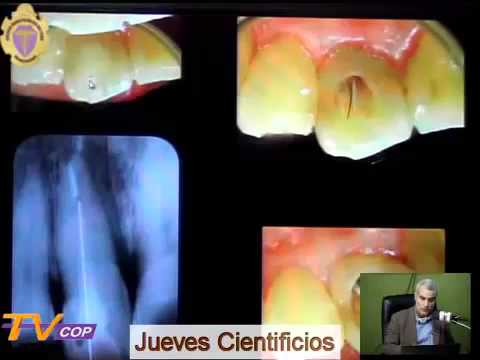 Accidentes en la endodoncia (Prevención y Tratamiento) - YouTube