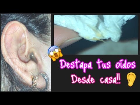 CÓMO DESTAPAR LOS OÍDOS CORRECTAMENTE DESDE CASA, DE MANERA NATURAL ...