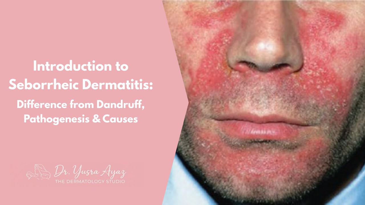 Lecture 1: Introduction to Seborrheic Dermatitis: Difference from ...