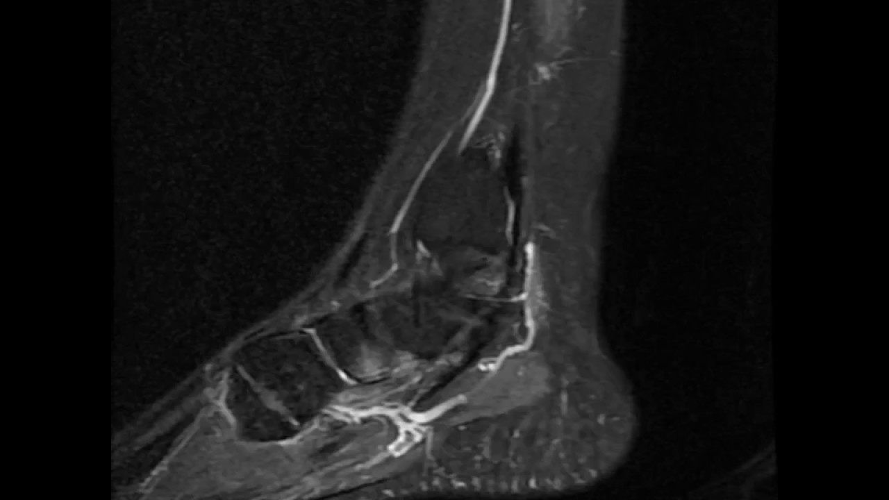 Os tibiale externum - sagittal T2 fat sat - YouTube