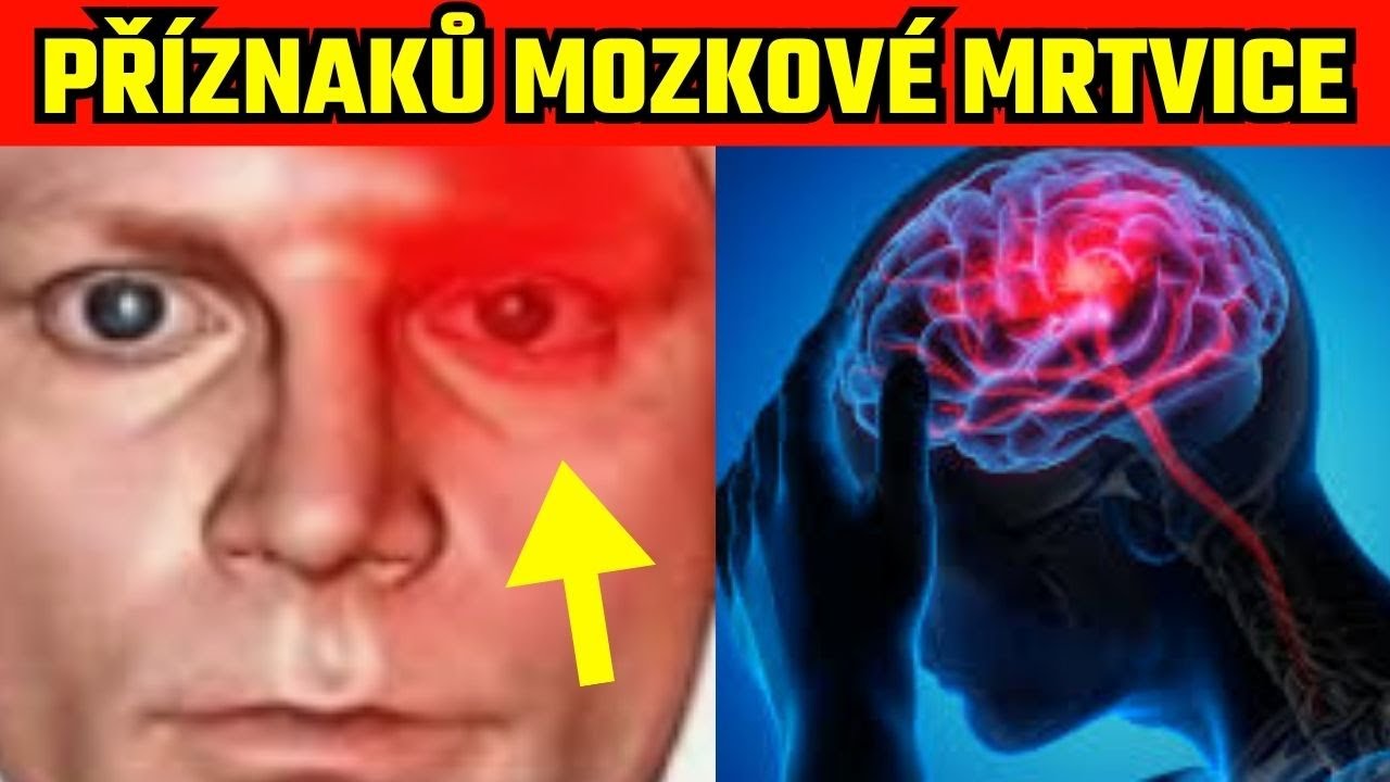 7 příznaků mozkové mrtvice, které se objeví 7 dní předem | ZDRAVÍ ...