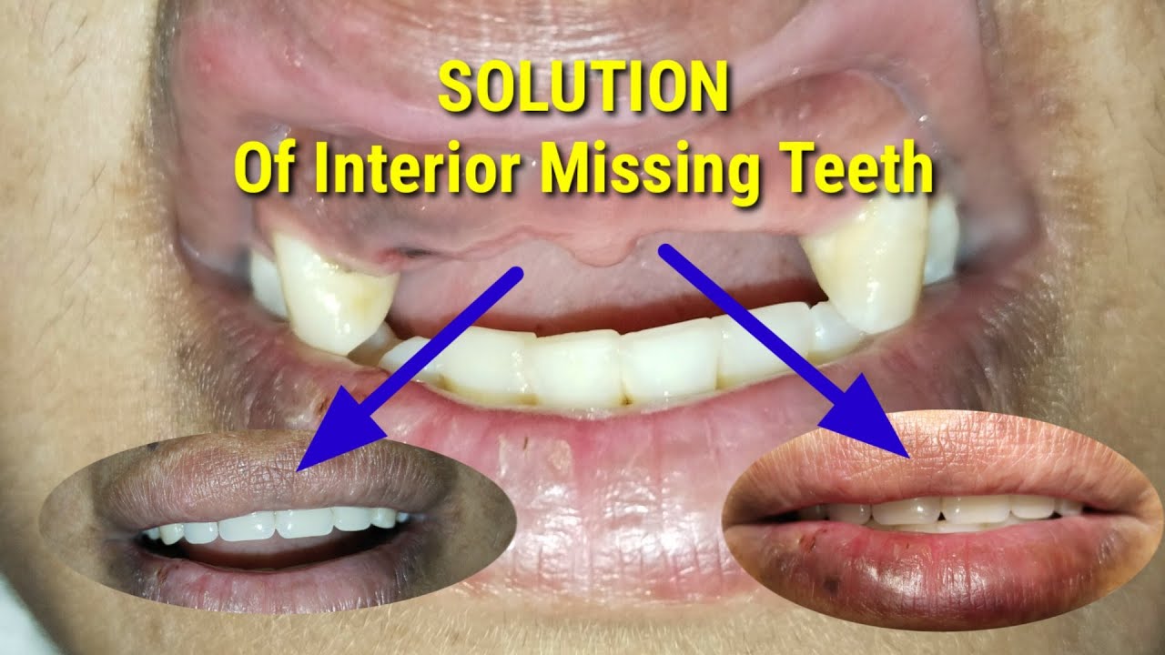 Removable Partial Denture By Haider || RPD Procedure || Dental Art By ...
