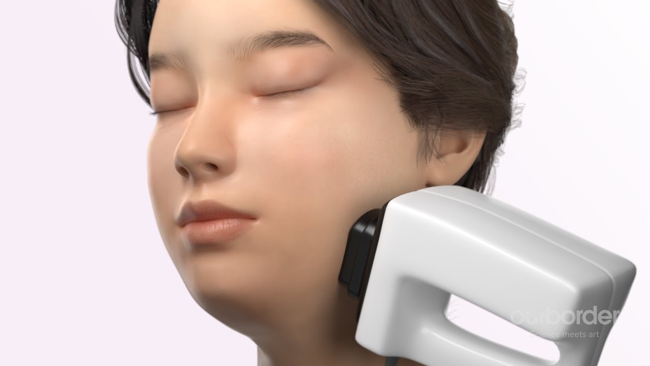 Inmode Mini Fx l 인모드 미니 Fx - YouTube